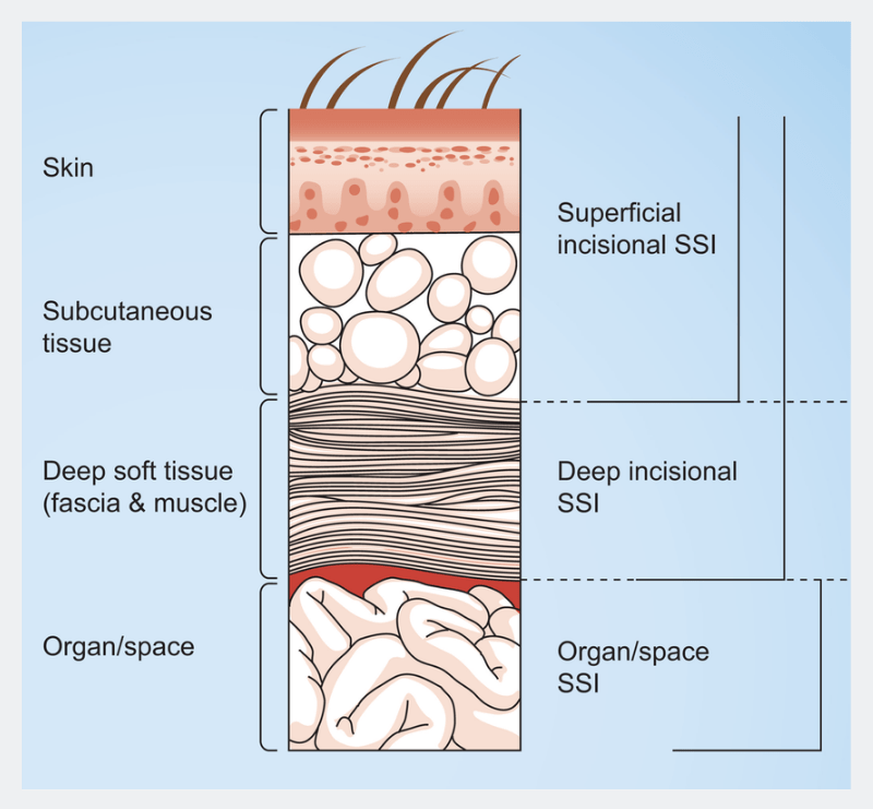 Reduce Post-Op Contamination Risk – Eloquest Healthcare, Inc.
