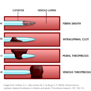 Pathway to Patency: Exploring the Challenges to Catheter Patency and ...